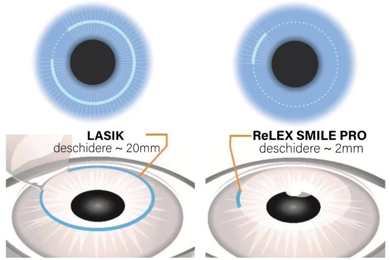 ReLEx SMILE PRO - Soluția Minim Invazivă pentru a scăpa de ochelari ...
